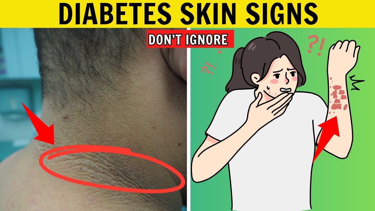 Don't Ignore! You Should Be Aware of These 10 Diabetes Skin Signs ...