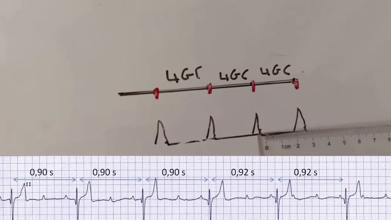 ECG: Interprétation très facile de L'ECG.(6ème partie). Mesure de La ...