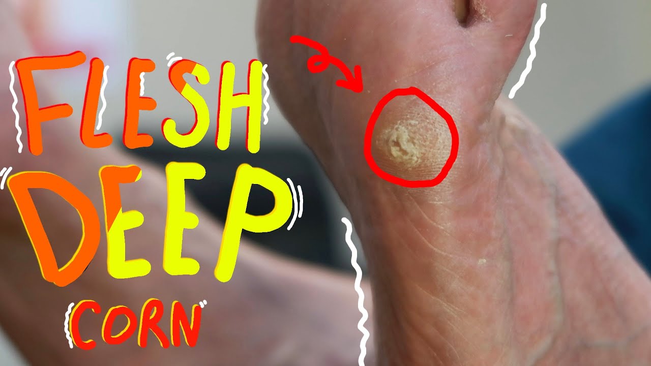 SUPER Satisfying DEEP Corn Removal: 10K SPECIAL!! - YouTube