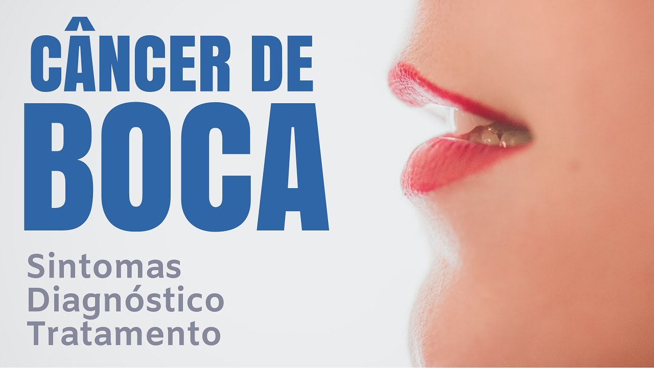 Câncer de Boca - Sintomas, Diagnóstico, Tratamento #cancerdeboca #saude ...