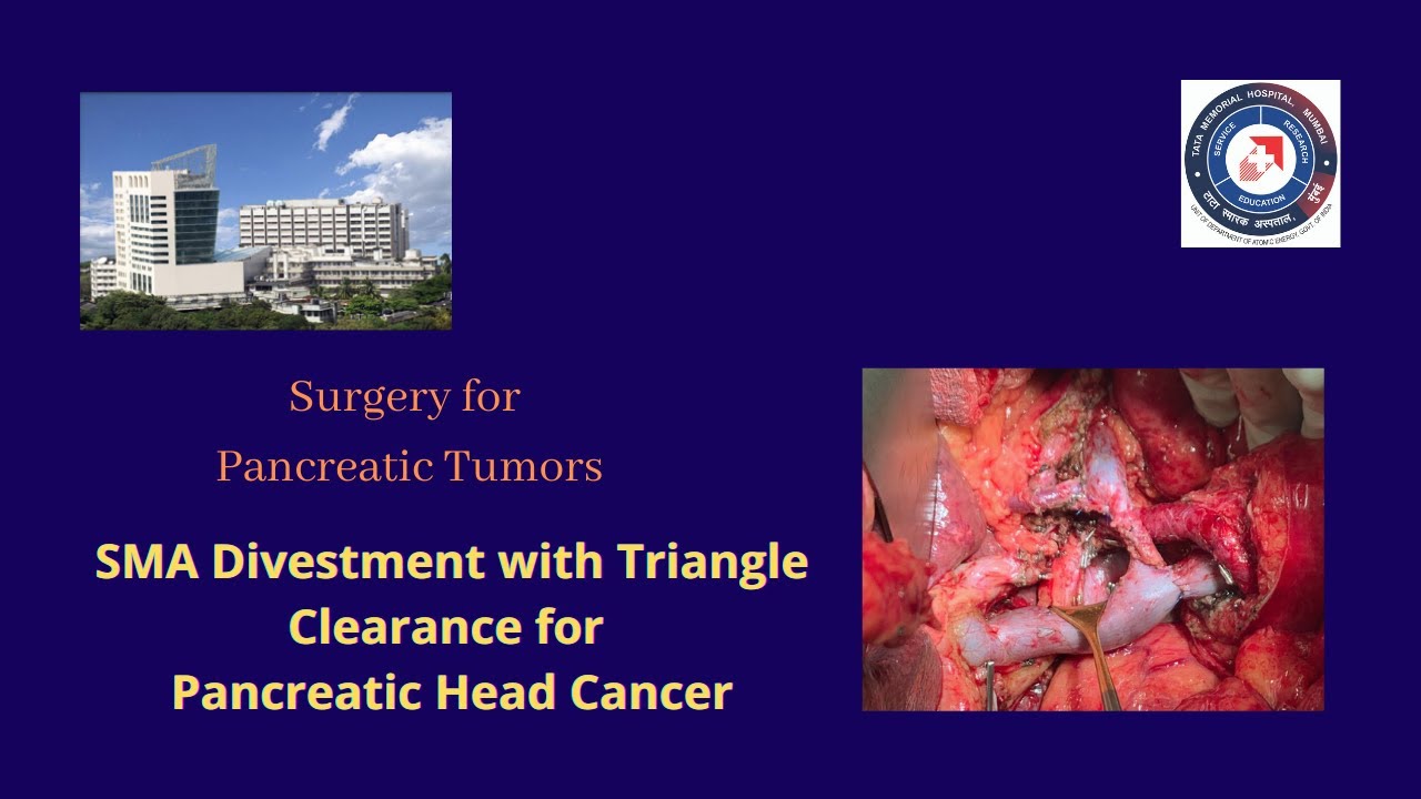 Triangle Clearance & SMA divestment, Borderline Resectable Pancreatic ...