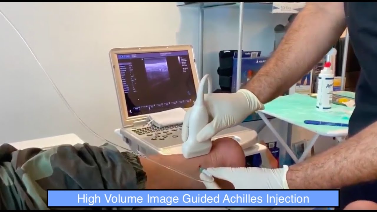 Achilles Tendon High Volume Image Guided Injection For Achilles Pain