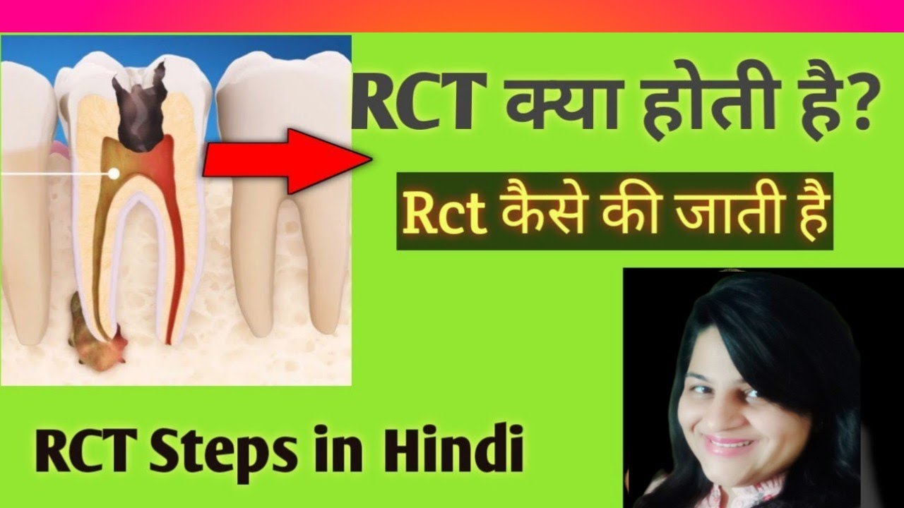 Rct procedure step by step in hindi| Rct treatment video| rct kaise ...
