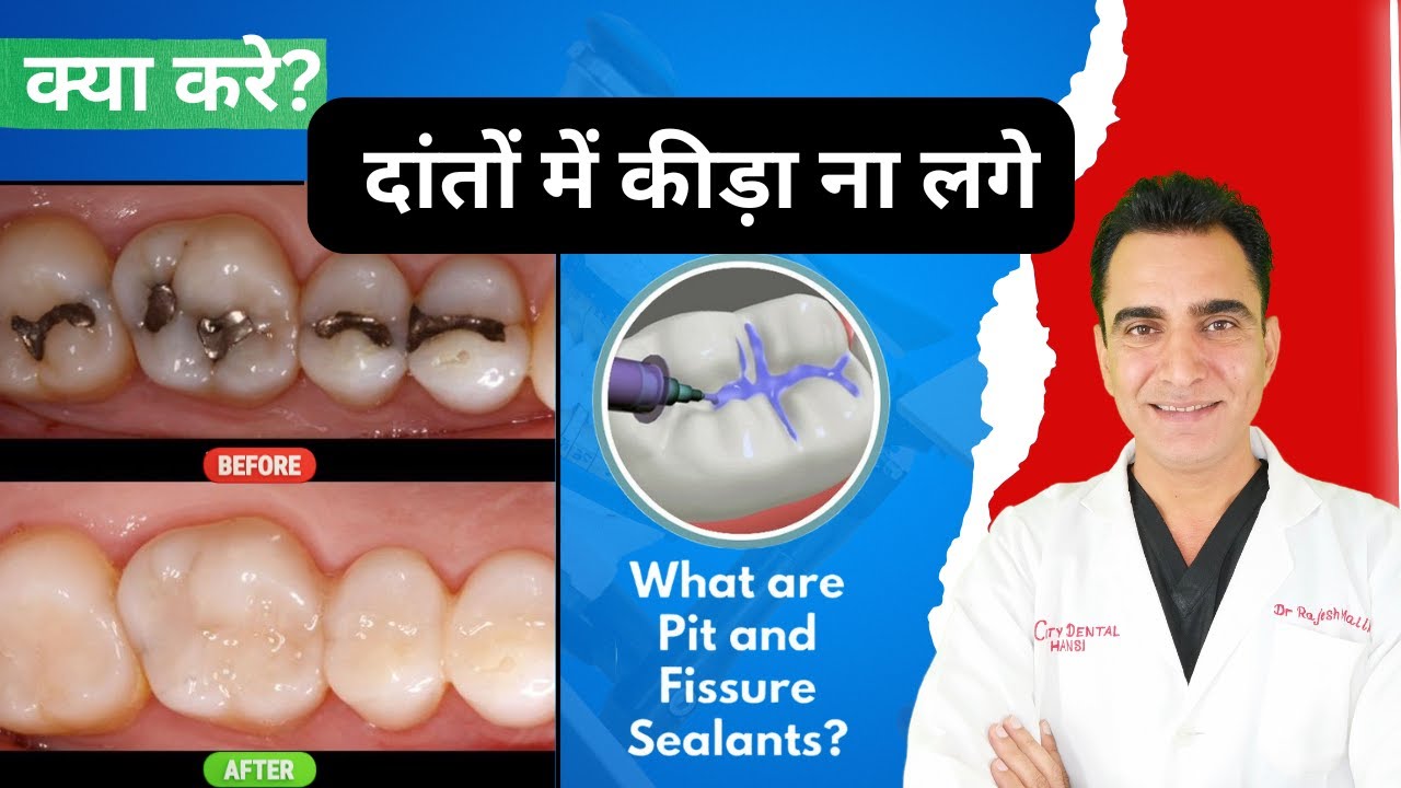 दाँतो को कीड़ा (Cavity) से बचाव व उपचार | Tooth Sealant | Teeth Lamination | Pit & Fissure ...