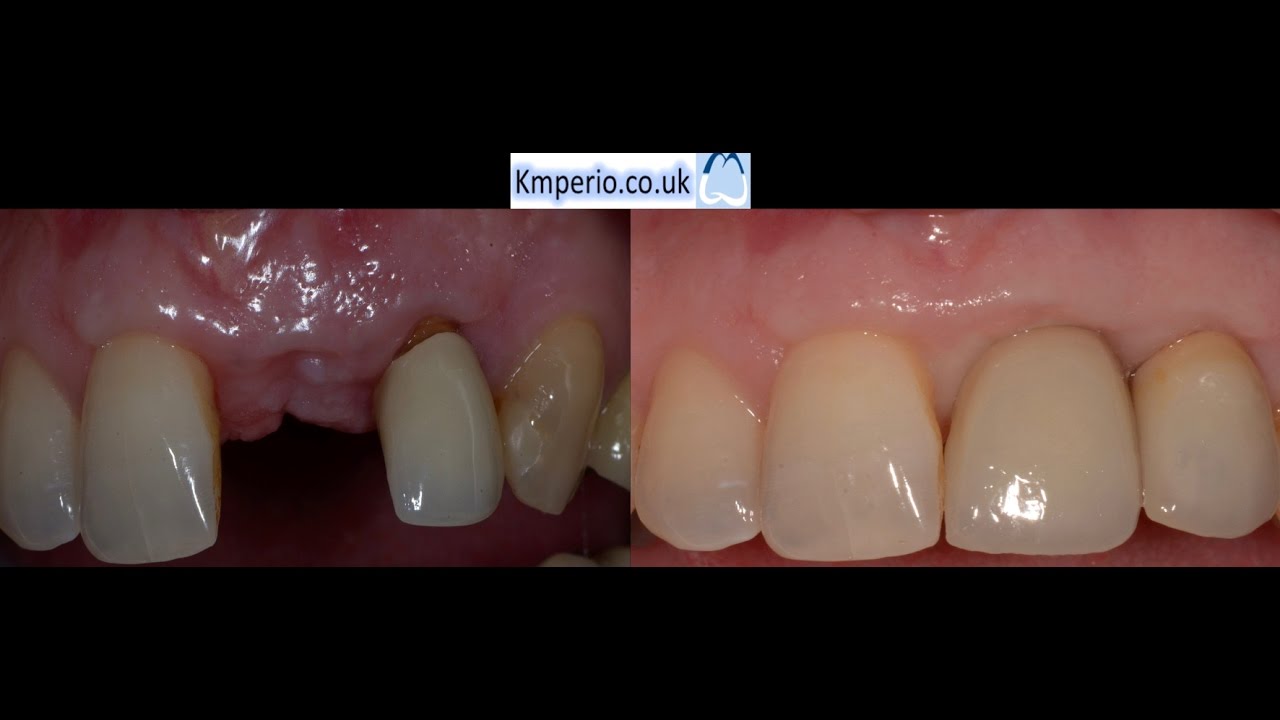 Extraction, Socket Grafting & Implant Restoration High Smile line ...