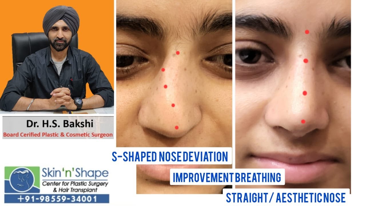 Severe Nose Deviation to Aesthetic Perfection: A Real Patient’s Story ...