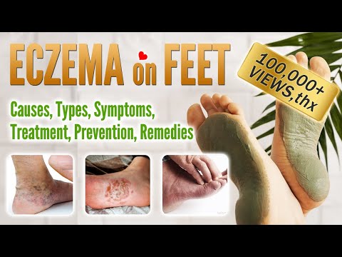 Eczema on foot Causes, Symptoms, Types, Treatment, Prevention and Home Remedies | Feet Eczema