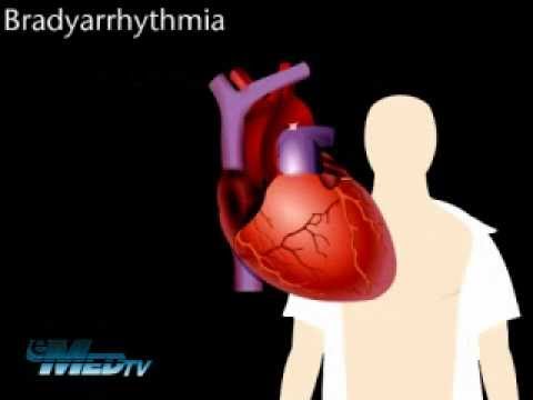 Bradyarrhythmia - Slow Heart Rhythm Overview - YouTube