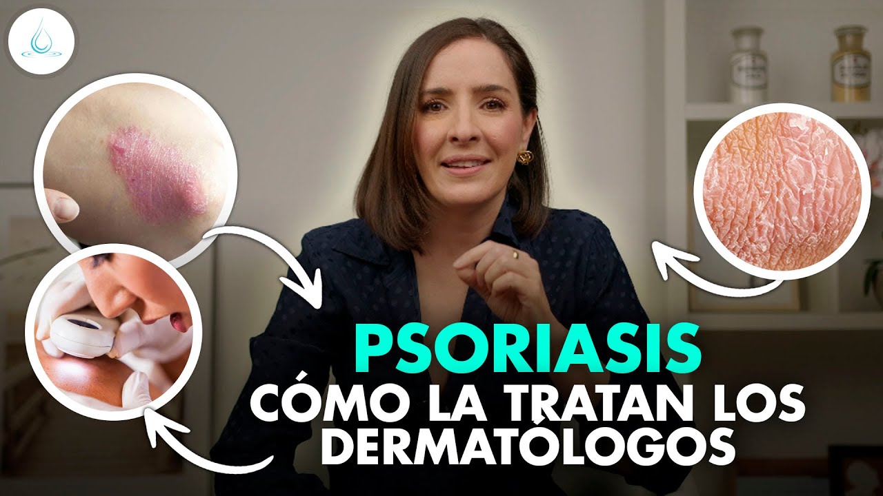 🔴 TRATAMIENTO para la PSORIASIS ¿Tiene CURA? | Te lo EXPLICO TODO ...
