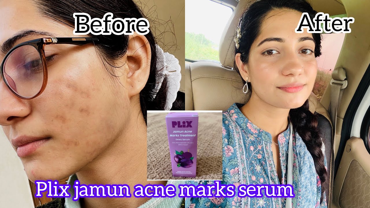 How I got rid of my acne marks by using just Plix Jamun 10% Niacinamide ...
