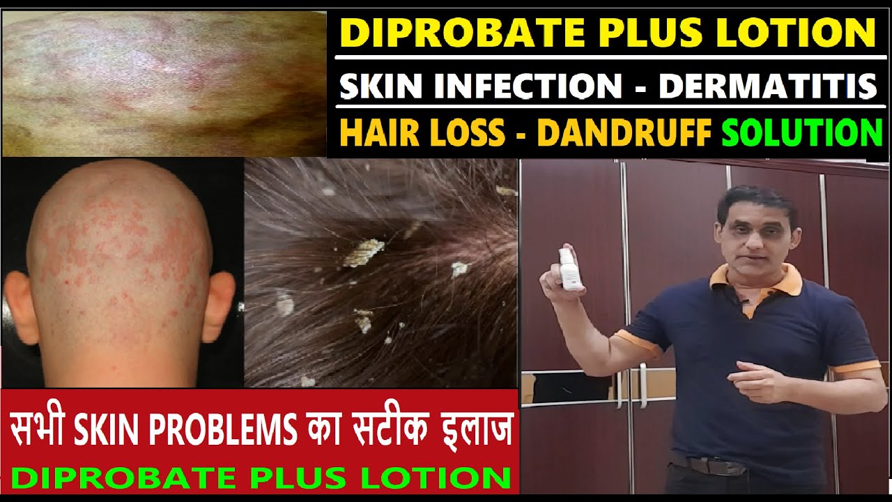 Diprobate Plus Lotion To Treat Dermatitis, Dandruff & All Skin Problems ...