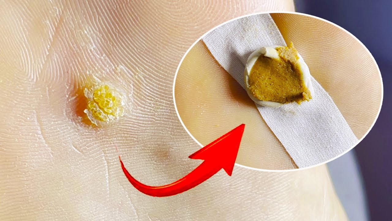 Seed Corn Removal: Quick removal with special herbs【Pedicure Master Lin ...