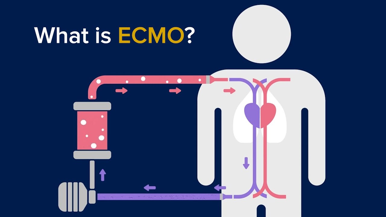 What is ECMO? - Lifesaving Support for Failing Organs (Including COVID ...