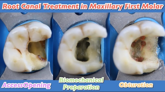 Root Canal Maxillary First Molar Anatomy RADICULOUS/ SMALL MOLARS/