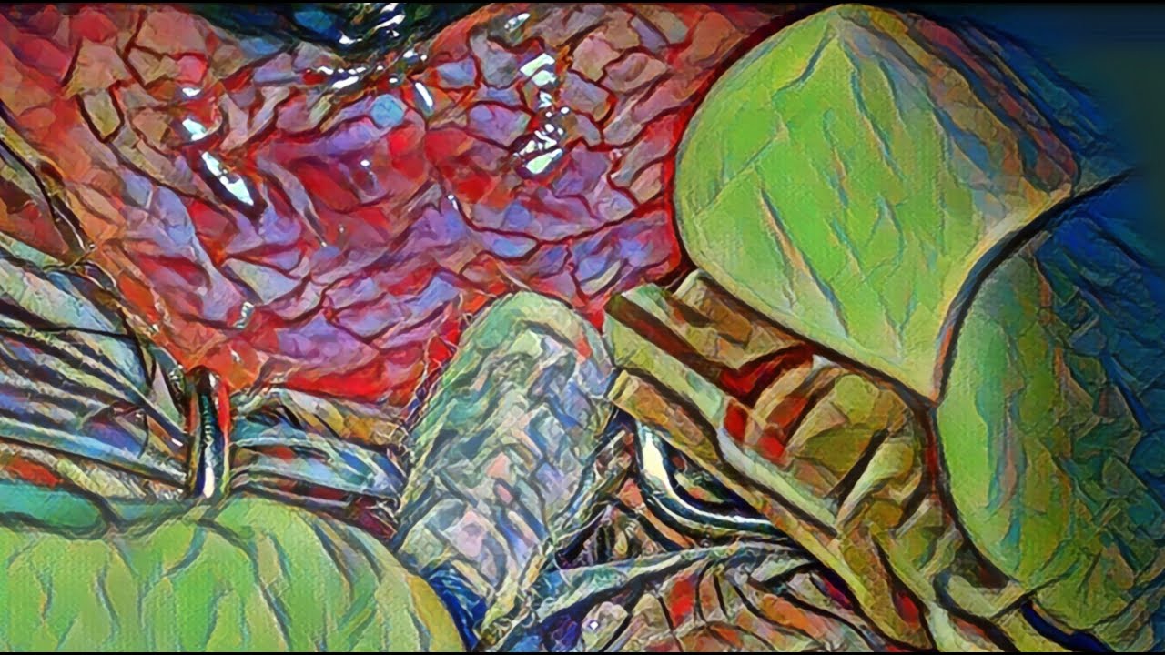 Bleb Needling - Routine POAG (Post-TRAB) - YouTube