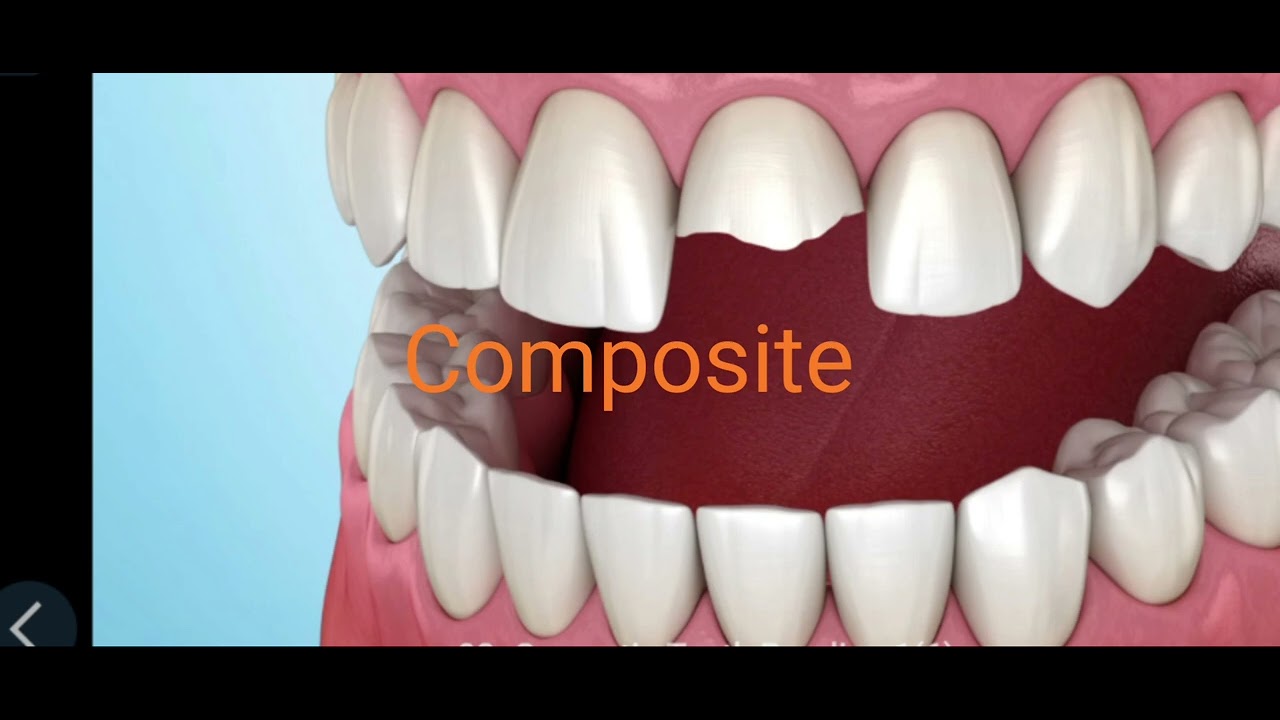 Step by step procedure composite restoration 21 - YouTube