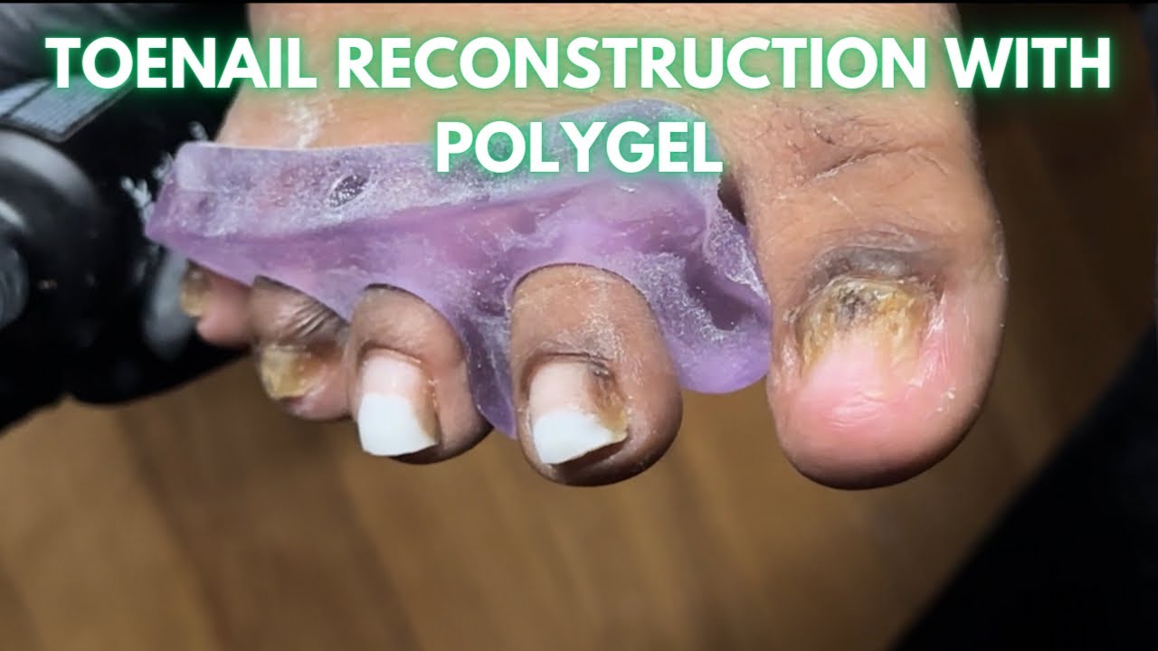 DEAD TOENAIL REMOVAL & RECONSTRUCTION 😱 TOENAIL SET WITH POLYGEL - YouTube