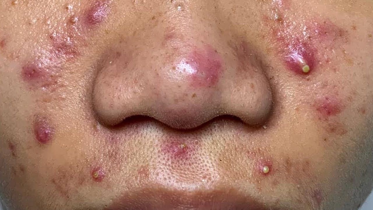 acne cystic extraction | acne treatment | acne treatments video ...
