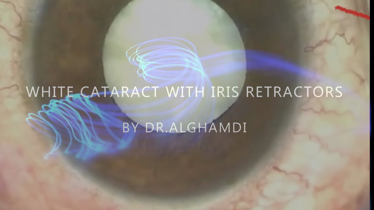 PHACO 16 WHITE CATARACT + IRIS RETRACTORS - YouTube