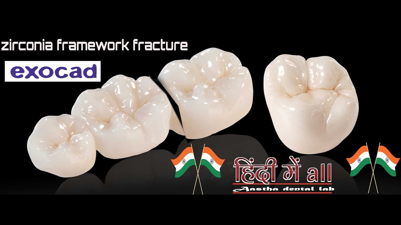 zirconia framework fracture || zirconia bridge fracture || Cracked ...