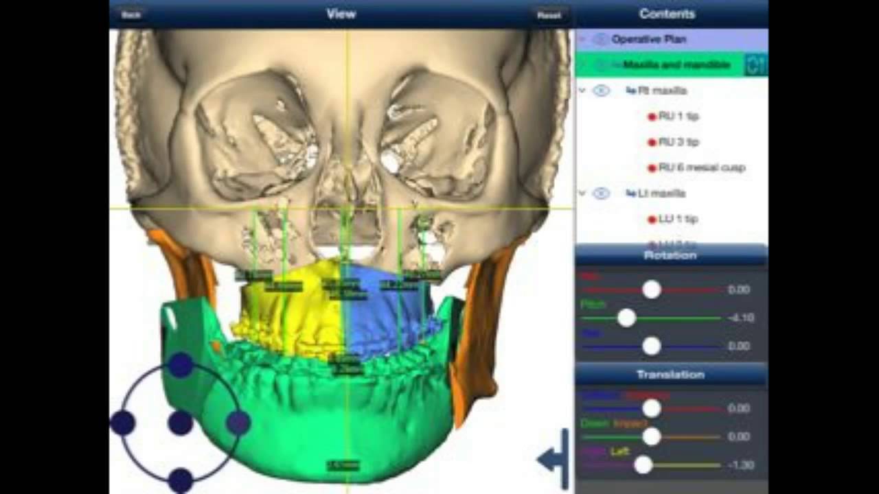 3D Cranio-maxillofacial or Orthognathic Planning Software - YouTube