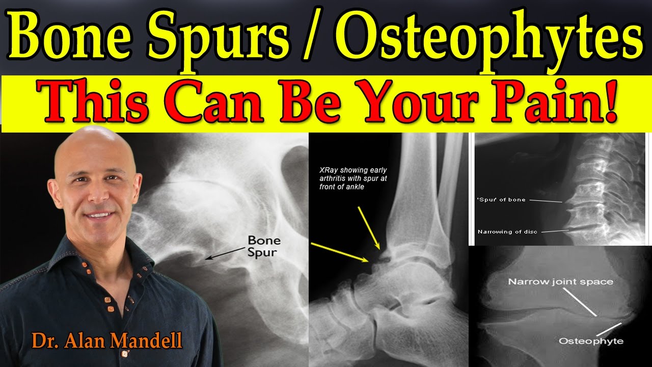 Bone Spurs/Osteophytes - This Can Be Your Pain - Dr Mandell - YouTube