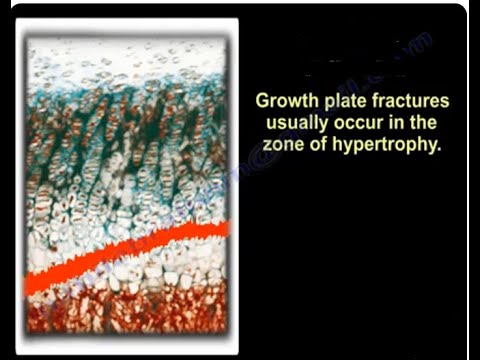 Growth Plate Fractures in Children: Salter-Harris Classification ...