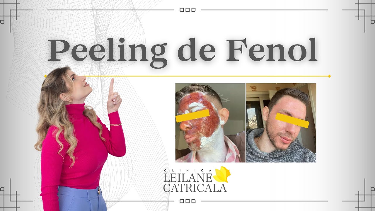 Peeling de Fenol: saiba tudo sobre esse procedimento - YouTube