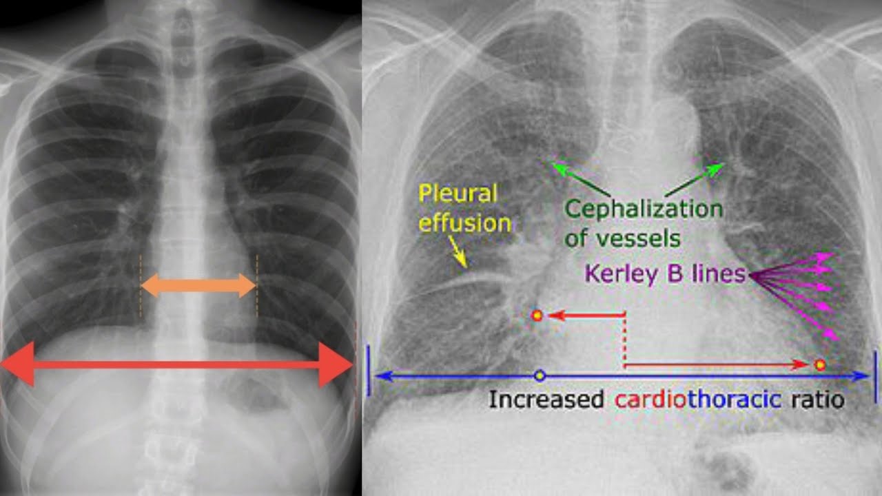 Microcardia in Addison's Disease: The Small Heart Syndrome - YouTube