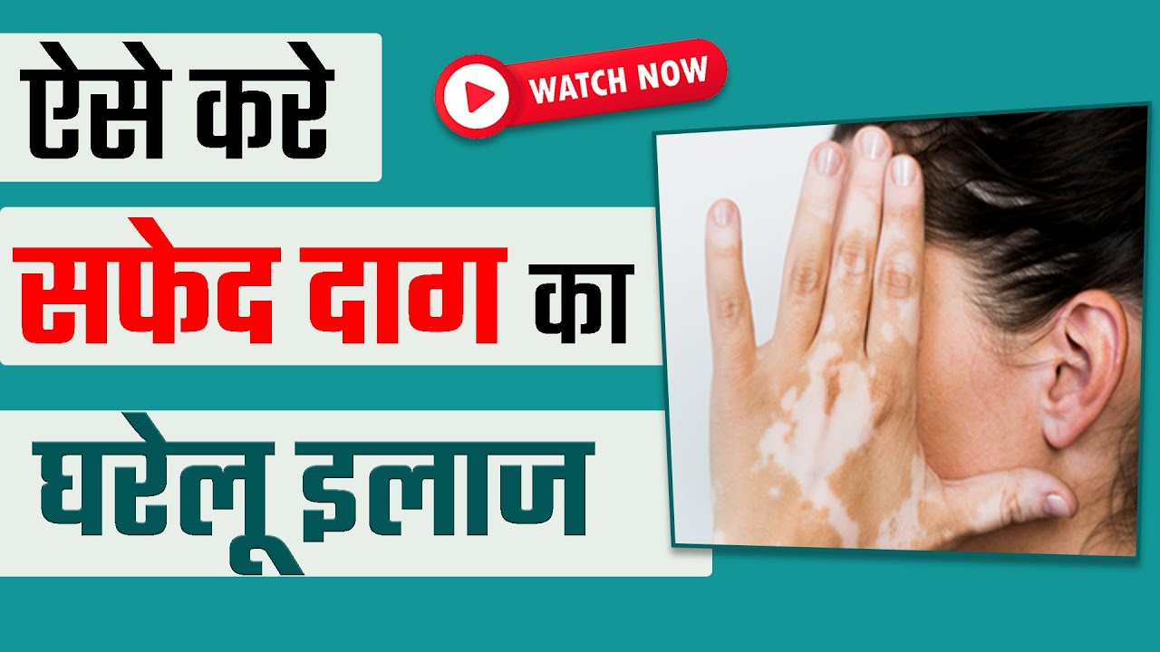 Vitiligo (Safed Daag) Jaldi Theek Karne Ke Gharelu Upay| Safed Daag Ka ...