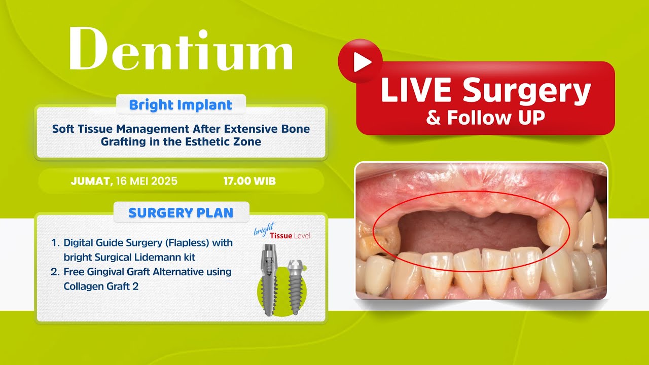 LIVE SURGERY – Soft Tissue Management Following Extensive Bone Grafting ...