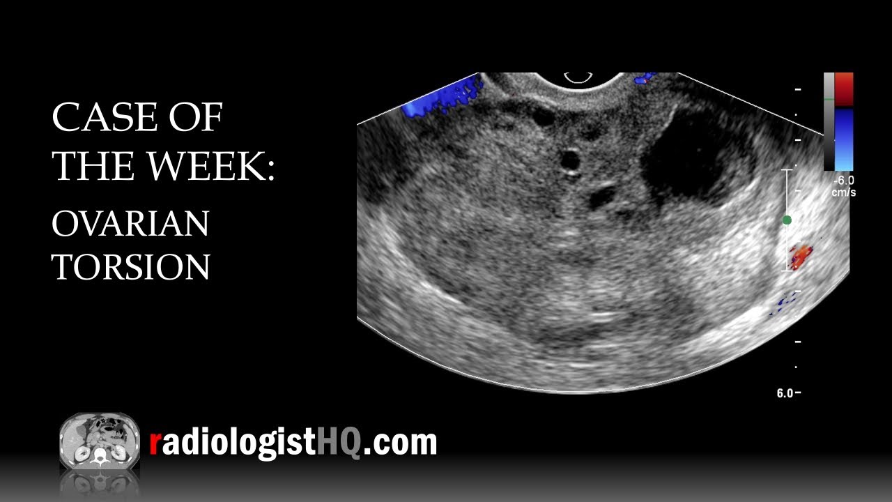 Case Of The Week Ovarian Torsion Ultrasound YouTube case-of-the-week-ovarian-torsion-ultrasound-youtube