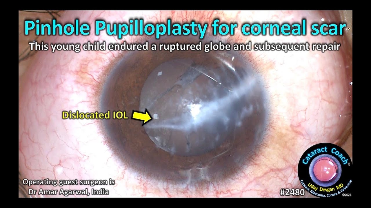 CataractCoach™ 2480: pinhole pupilloplasty for corneal scar with glued ...