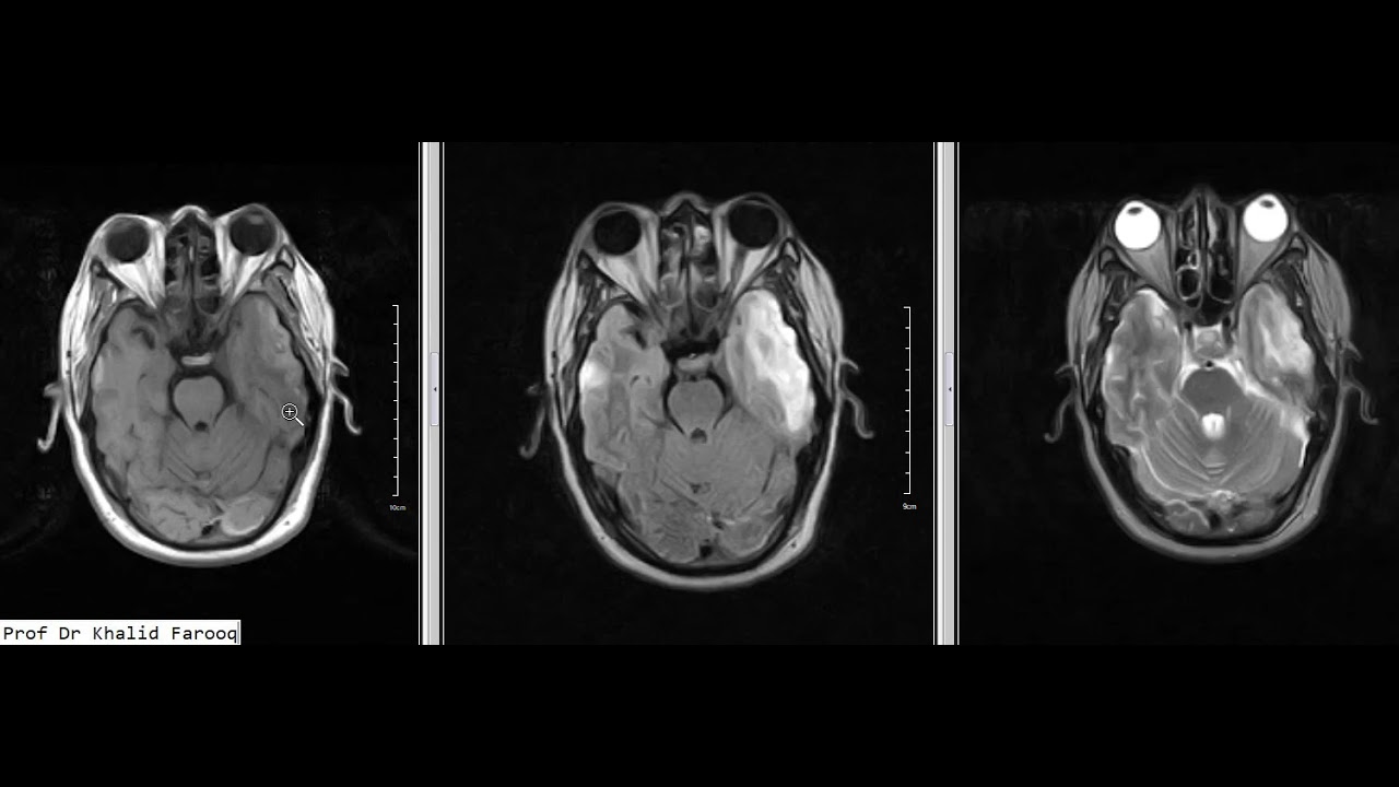 mri brain post traumatic hemorrhagic contusion - YouTube