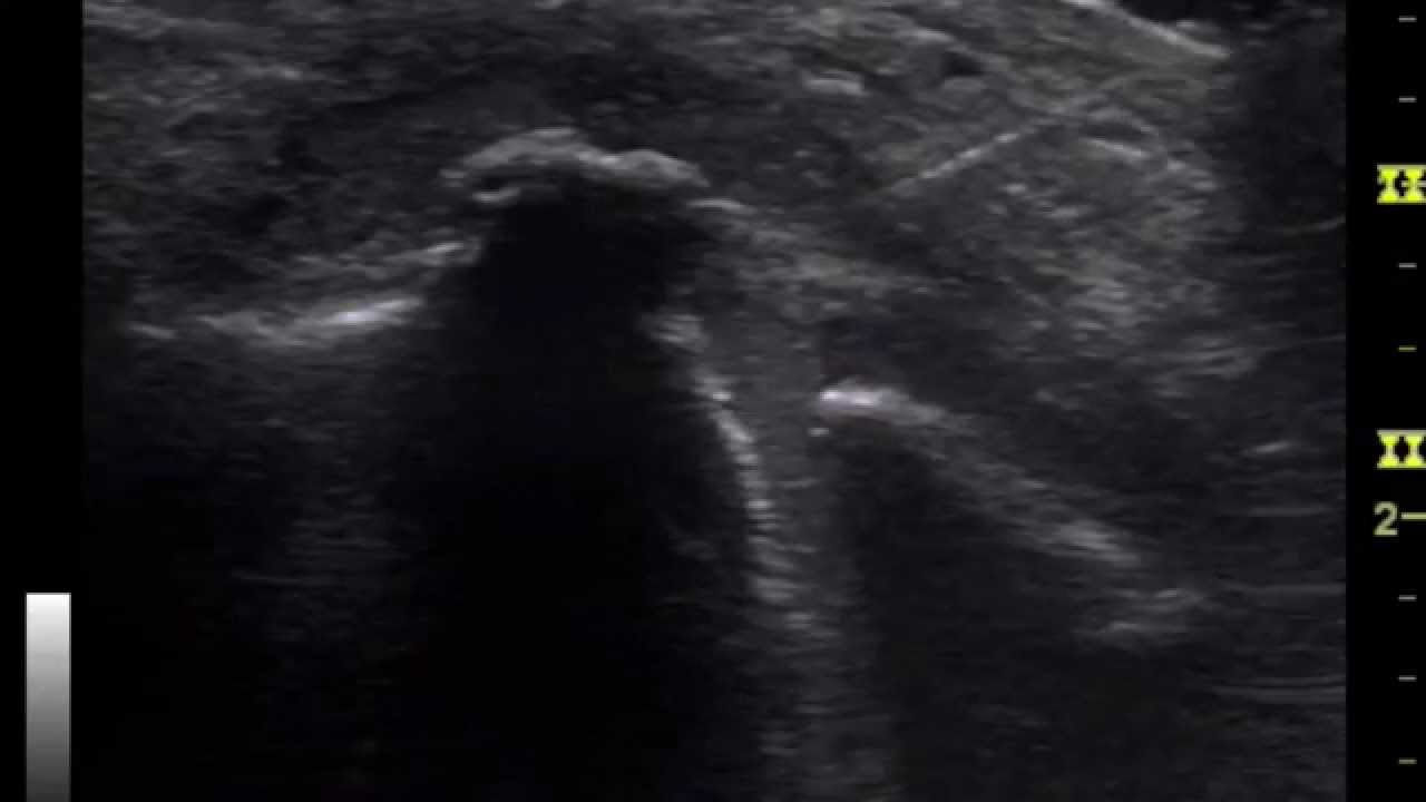 US Guided TNJ Injection - YouTube