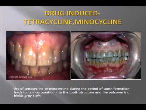 Intrinsic stains on teeth.wmv - YouTube