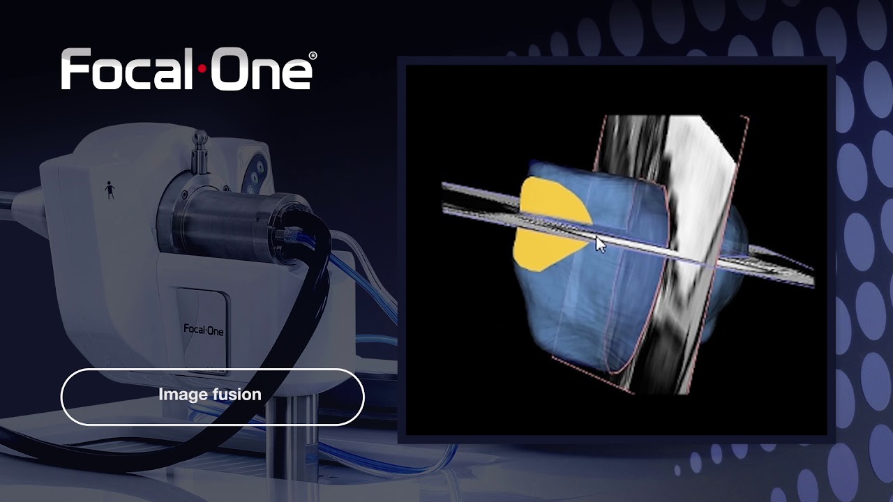 Focal One HIFU device now available in the US - YouTube