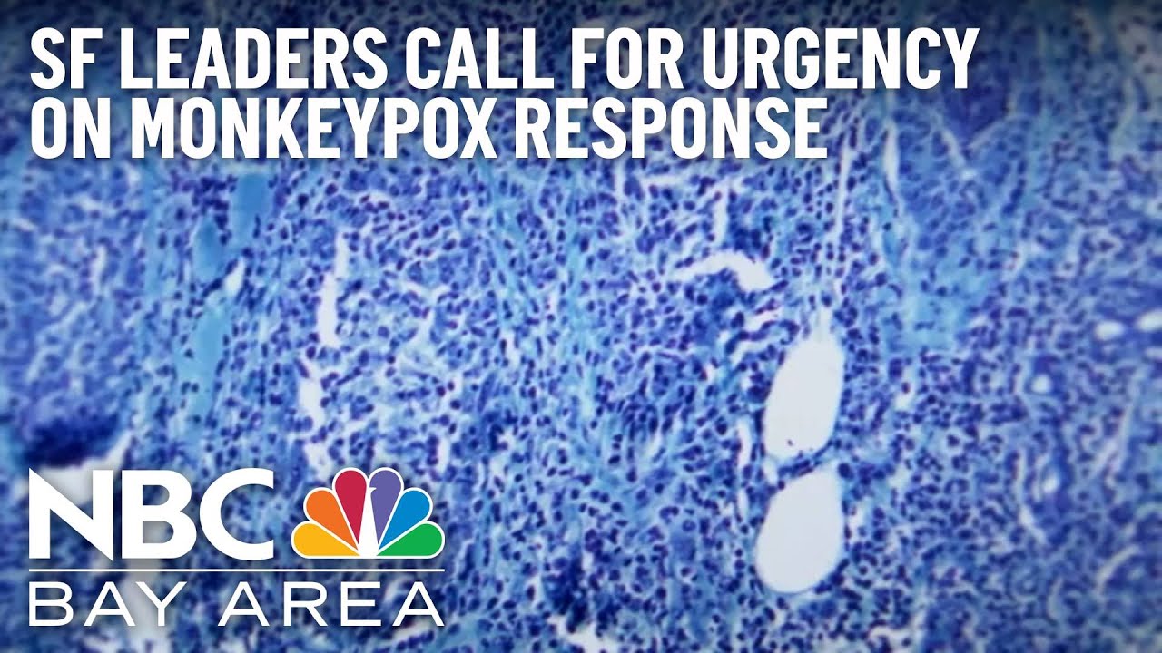 Rise in Monkeypox Cases Prompts Calls for More Urgent Response - YouTube