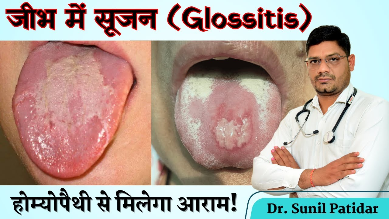जीभ में सूजन (Glossitis) का इलाज | Tongue Swelling Homeopathic ...