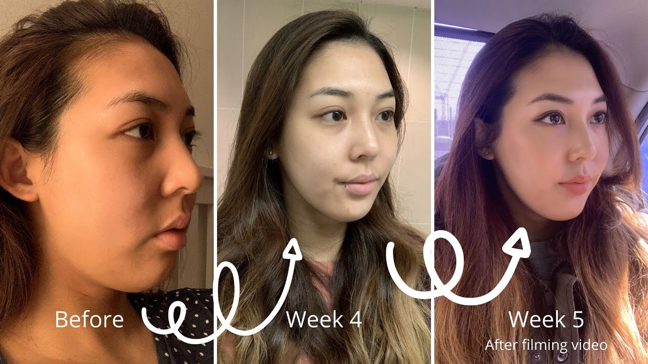 Double Chin to V-line! I Got Face Liposuction in Korea! Feat. Eunogo ...