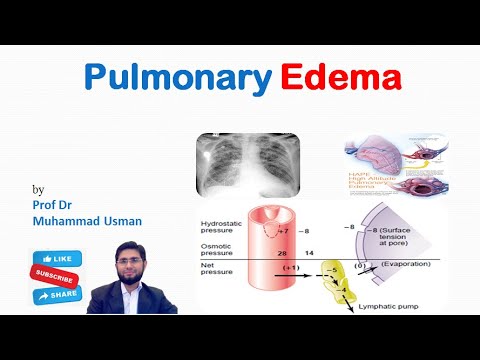 Pulmonary Edema | Pulmonary Interstitial Fluid formation | Safety ...