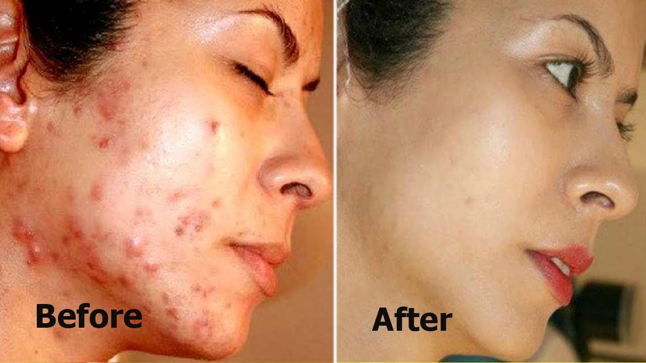 Acne Removal \ Get Rid Of Pimples On Face With Natural Ingredients At ...