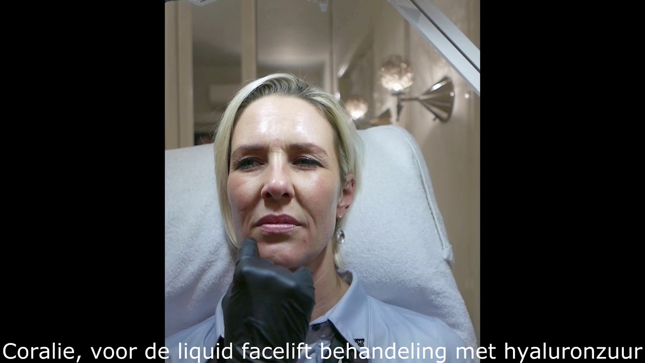 Liquid facelift en littekencorrectie met hyaluronzuur-Nadine Gregoire ...