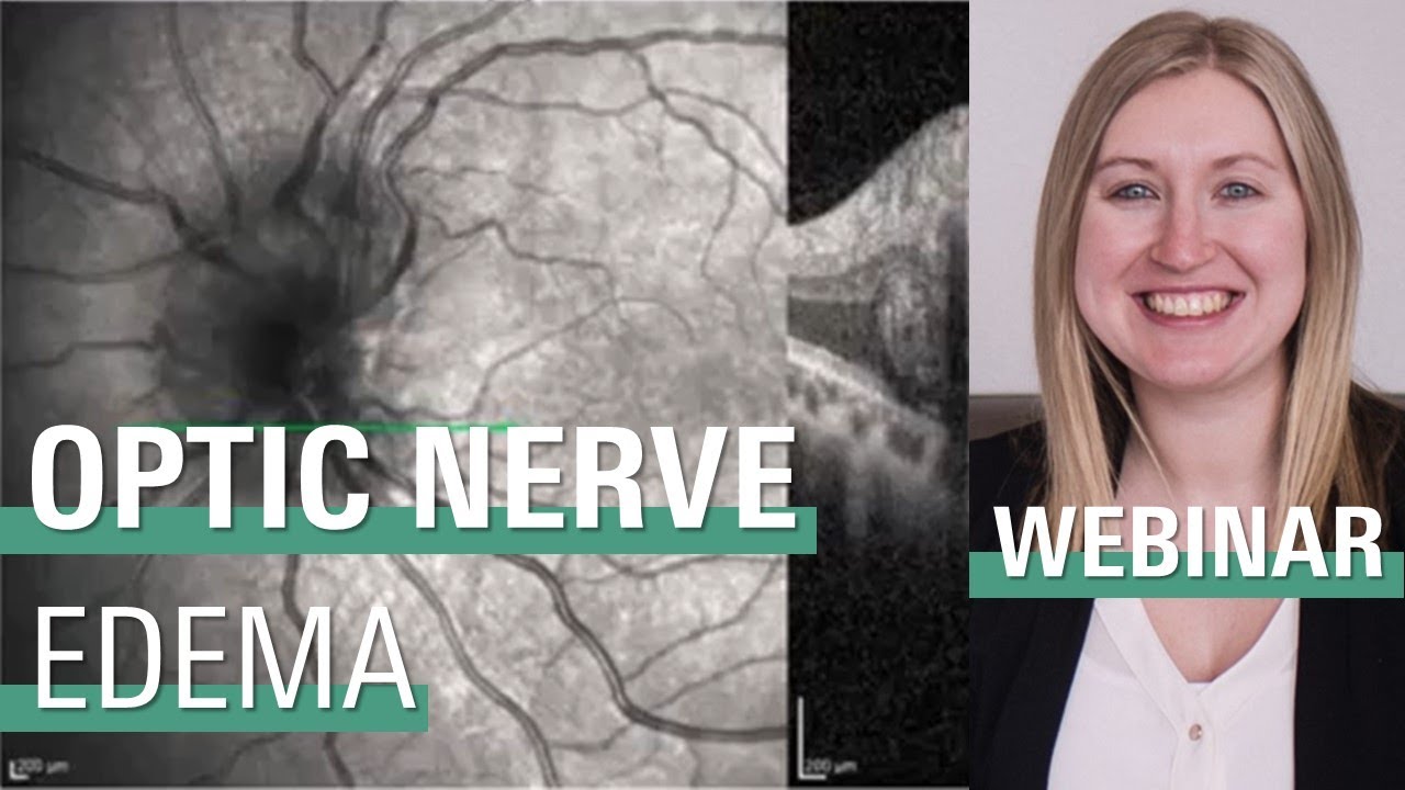Optimizing OCT for Optic Nerve Edema in Pediatric and Adult Patients ...