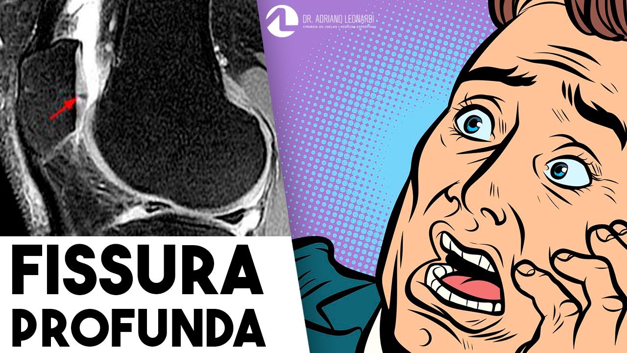 Fissura Condral Profunda Tratamento - RETOEDU