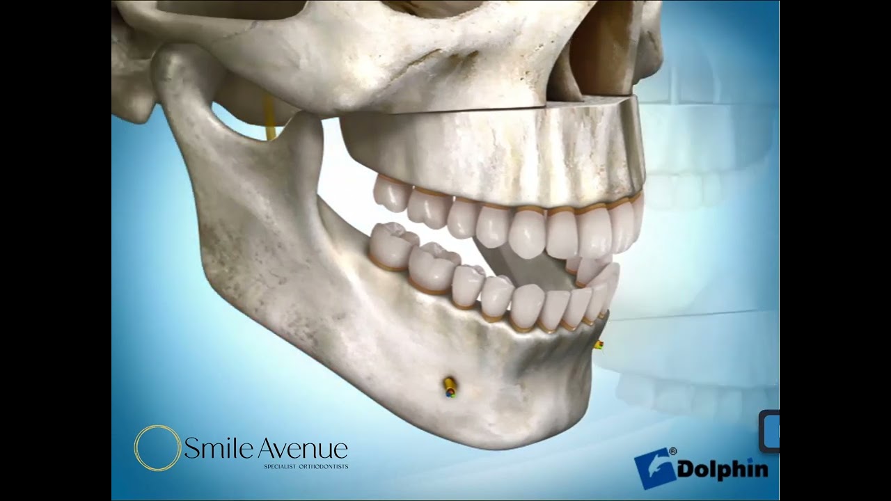 Maxillary Prognathism Overbite
