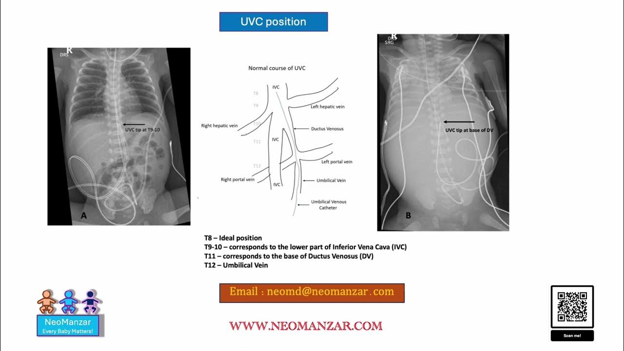 Umbilical Venous Catheter (UVC) position (NICU) - YouTube