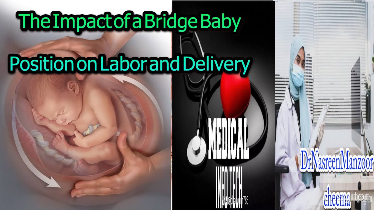 The Impact of a Bridge Baby Position on Labor and Delivery - YouTube