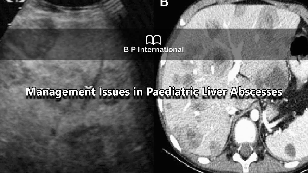Management Issues in Paediatric Liver Abscesses - YouTube