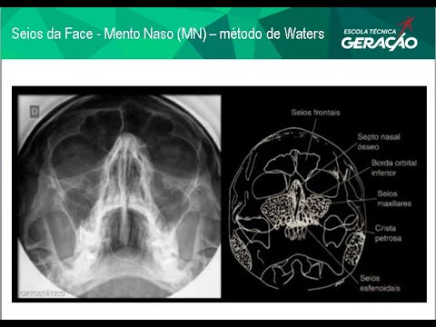 Radiografia dos Seios da Face - método de Water ou Mento Naso (MN)